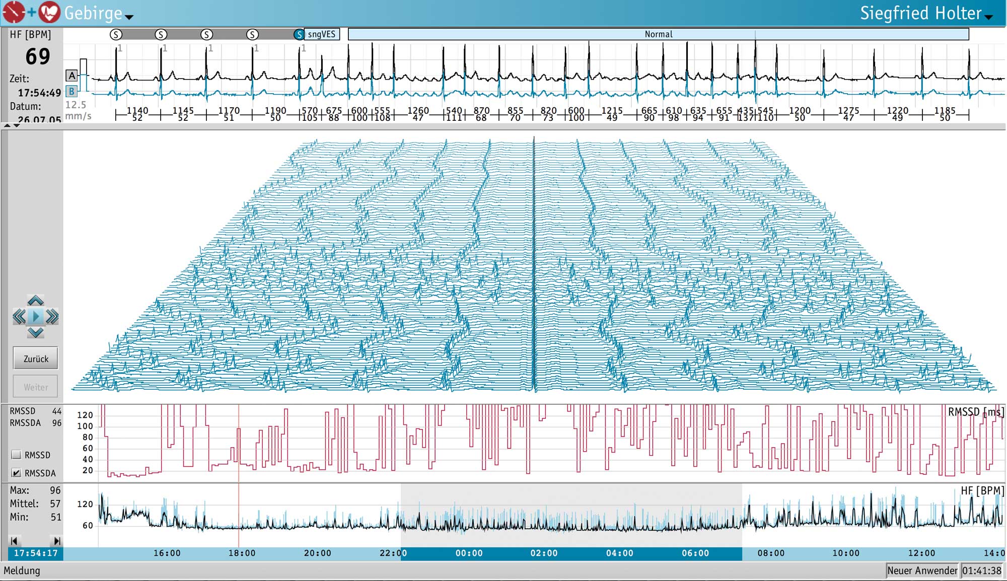 Wie Sieht Ein Langzeit Ekg Aus